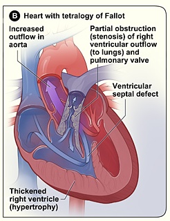 Steno-Fallot’s tetralogy, the mystery of “blue babies”